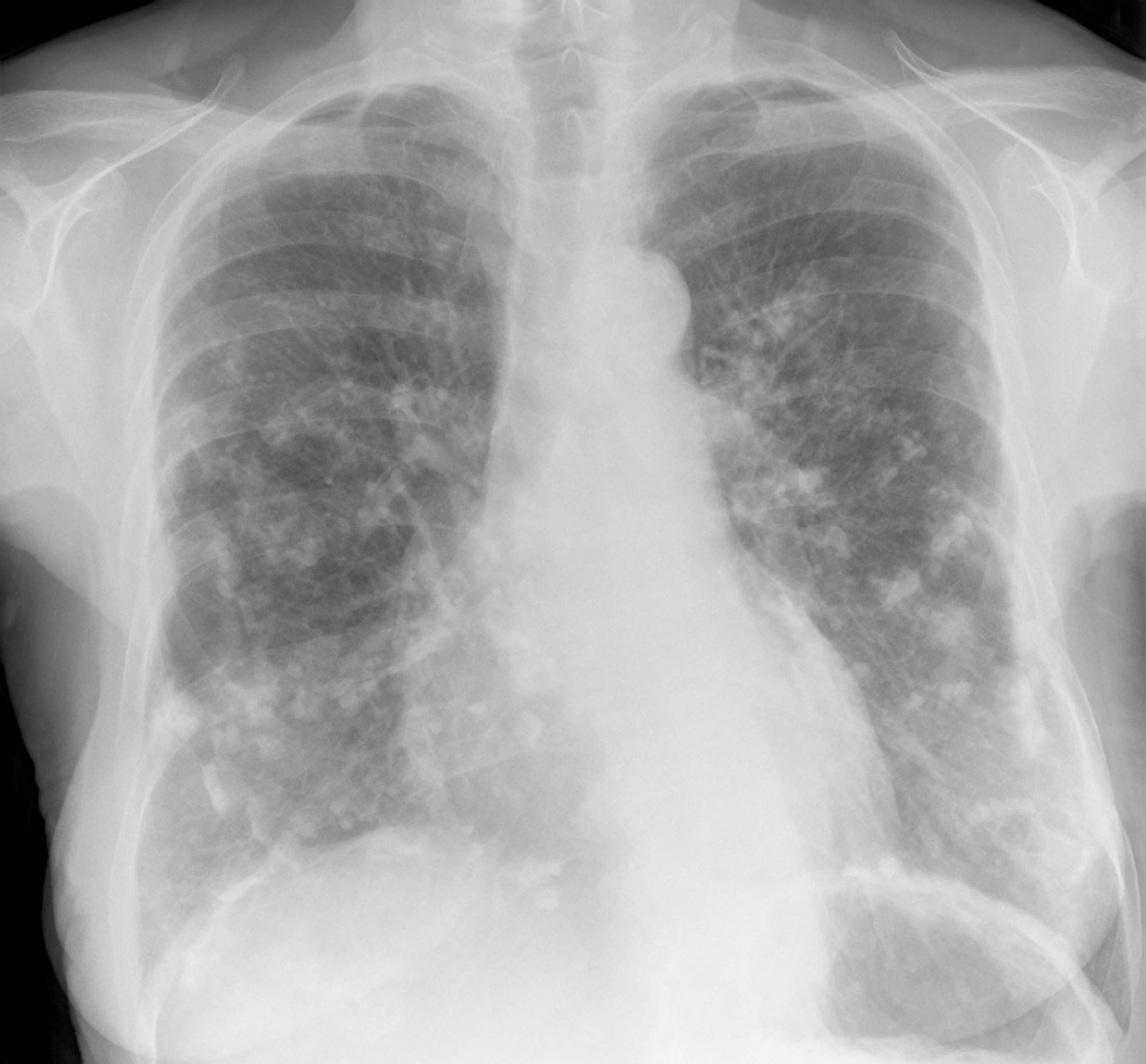 Pleural Plaques From Asbestos Exposure and Mesothelioma