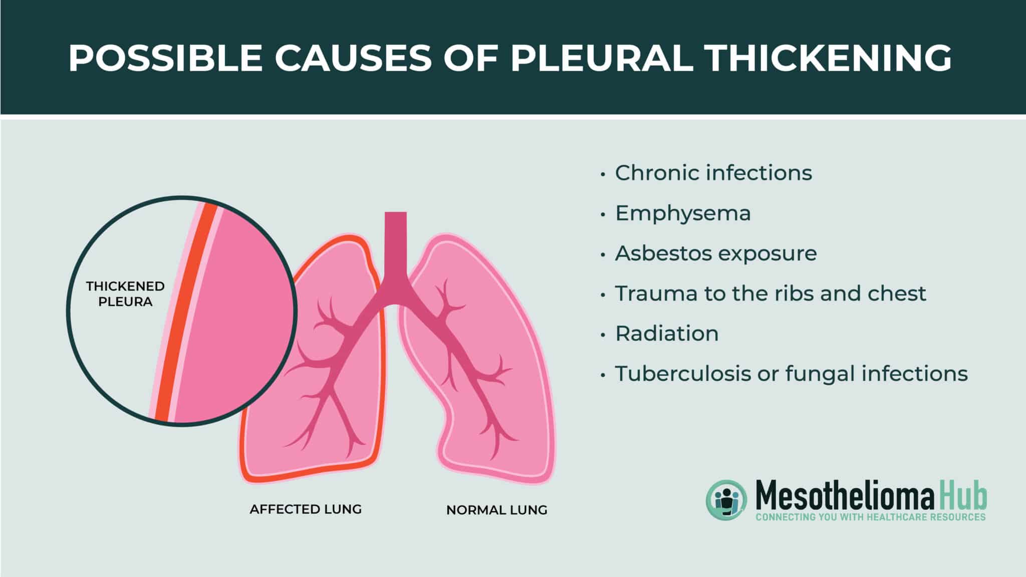 Pleural Thickening - Symptoms, Diagnosis, and Treatments