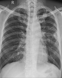 Pleural Thickening - Symptoms, Diagnosis, and Treatments
